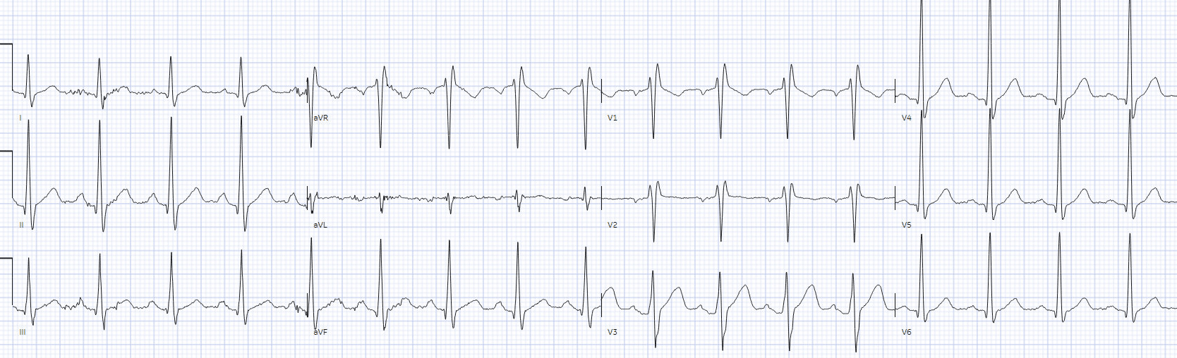 ECG Interpretation in Toxicology | ECG Cases | EM Cases