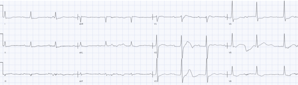 Ecg Interpretation In Toxicology Ecg Cases Em Cases