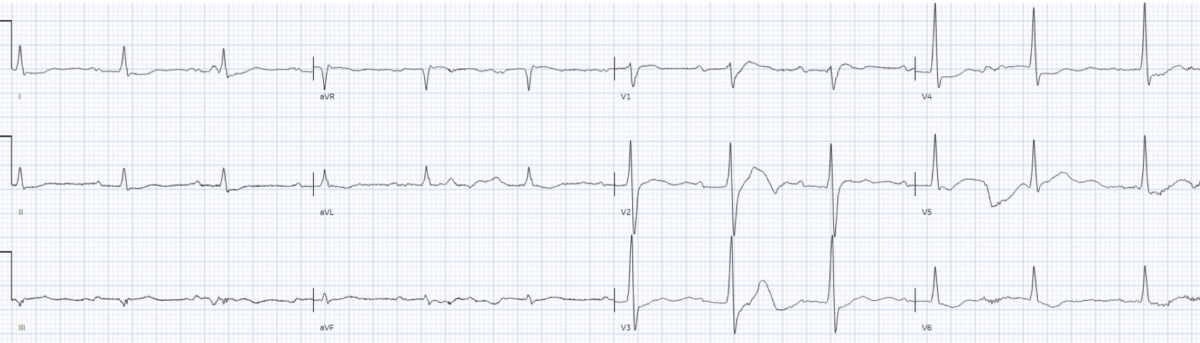 ECG Interpretation in Toxicology | ECG Cases | EM Cases