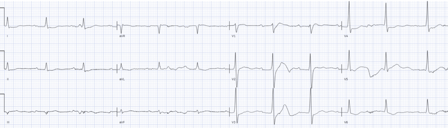 ECG Interpretation in Toxicology | ECG Cases | EM Cases