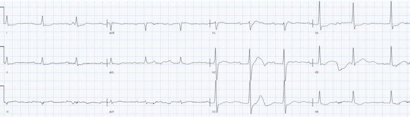 ECG Interpretation in Toxicology | ECG Cases | EM Cases