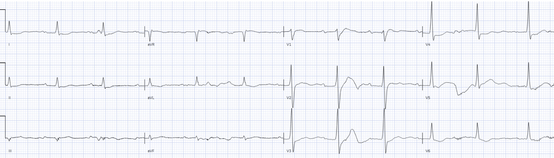 ECG Interpretation in Toxicology | ECG Cases | EM Cases