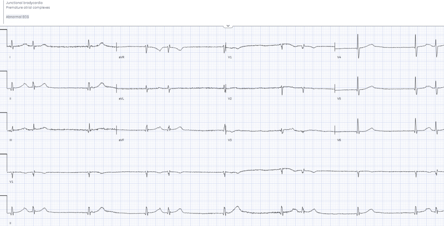ECG Interpretation in Toxicology | ECG Cases | EM Cases