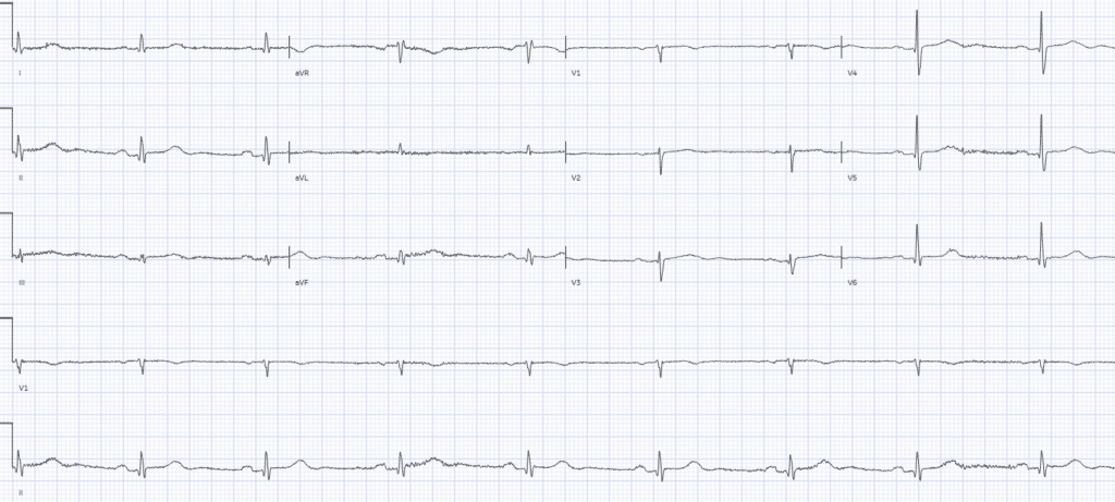 ECG Interpretation in Toxicology | ECG Cases | EM Cases