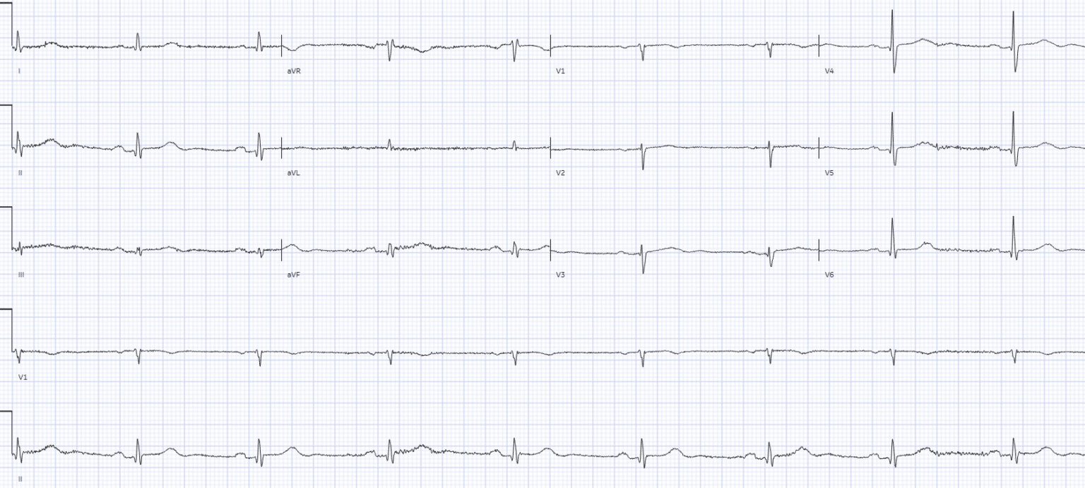 ECG Interpretation in Toxicology | ECG Cases | EM Cases