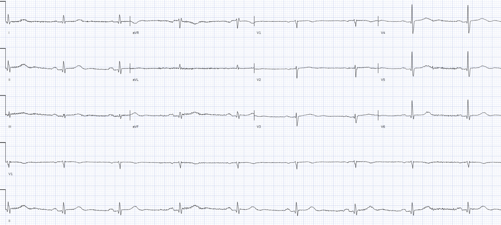 ECG Interpretation in Toxicology | ECG Cases | EM Cases