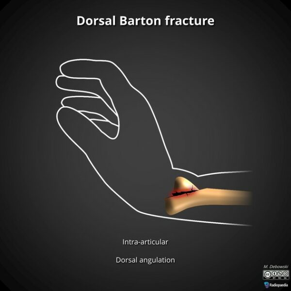 Commonly Missed or Mismanaged Wrist Injuries | Emergency Medicine Cases