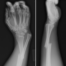 Commonly Missed or Mismanaged Wrist Injuries | Emergency Medicine Cases