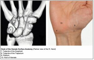 Carpal Bone Injuries - The Big 4 | Emergency Medicine Cases