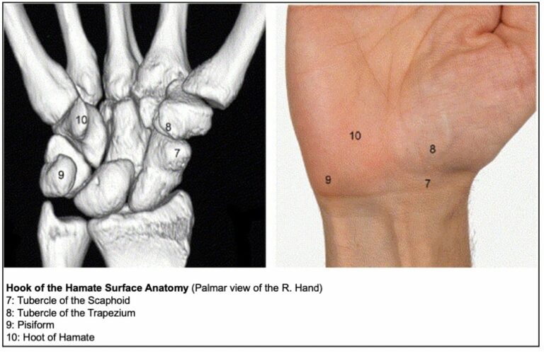 Carpal Bone Injuries - The Big 4 | Emergency Medicine Cases