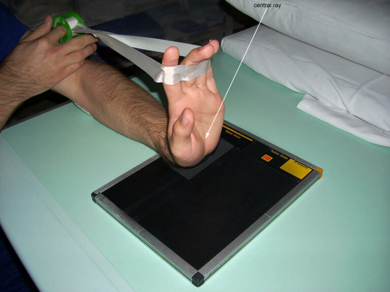 Carpal Bone Injuries - The Big 4 | Emergency Medicine Cases