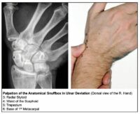 Carpal Bone Injuries - The Big 4 | Emergency Medicine Cases