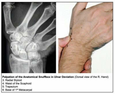 Carpal Bone Injuries - The Big 4 | Emergency Medicine Cases