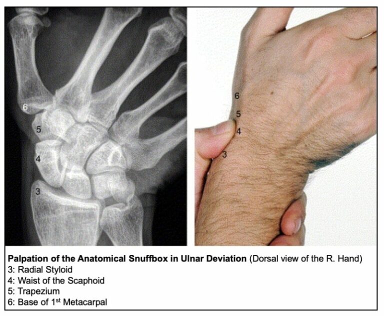 Carpal Bone Injuries - The Big 4 | Emergency Medicine Cases