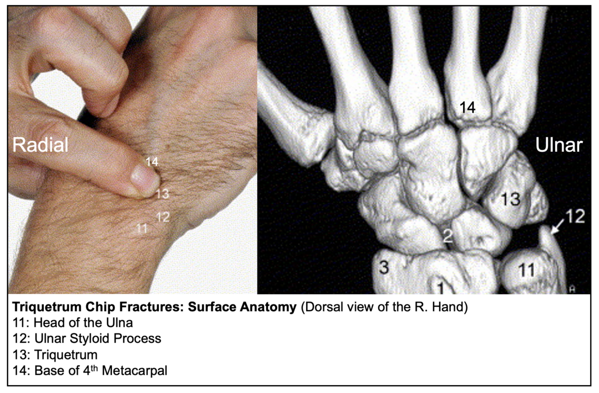 Carpal Bone Injuries - The Big 4 | Emergency Medicine Cases