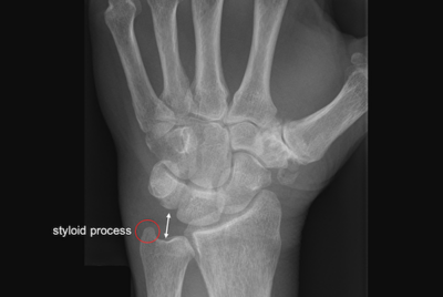 Commonly Missed or Mismanaged Wrist Injuries | Emergency Medicine Cases