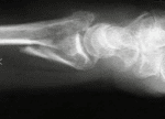 Commonly Missed or Mismanaged Wrist Injuries | Emergency Medicine Cases