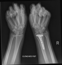 Carpal Bone Injuries - The Big 4 | Emergency Medicine Cases