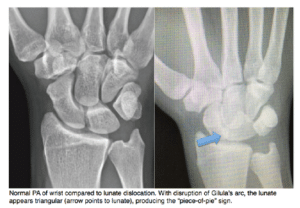 Commonly Missed or Mismanaged Wrist Injuries | Emergency Medicine Cases