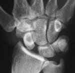 Commonly Missed or Mismanaged Wrist Injuries | Emergency Medicine Cases