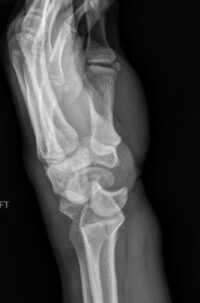 Commonly Missed or Mismanaged Wrist Injuries | Emergency Medicine Cases