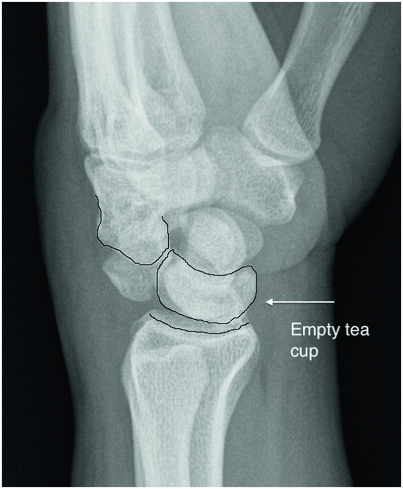 Carpal Bone Injuries - The Big 4 | Emergency Medicine Cases