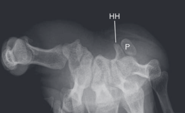 Carpal Bone Injuries - The Big 4 | Emergency Medicine Cases