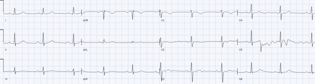 ECG Interpretation in Cardiac Arrest | ECG Cases | Emergency Medicine Cases