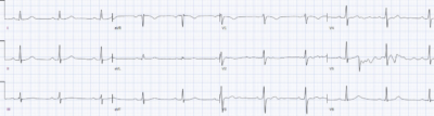 ECG Interpretation in Cardiac Arrest | ECG Cases | Emergency Medicine Cases