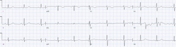 ECG Interpretation in Cardiac Arrest | ECG Cases | Emergency Medicine Cases