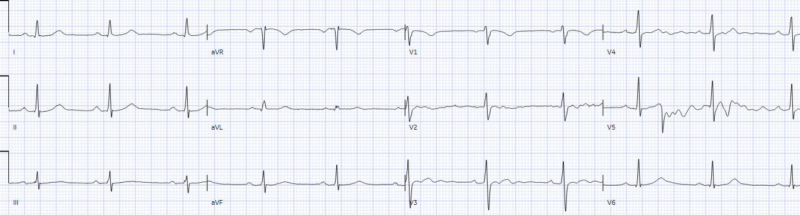 ECG Interpretation in Cardiac Arrest | ECG Cases | Emergency Medicine Cases