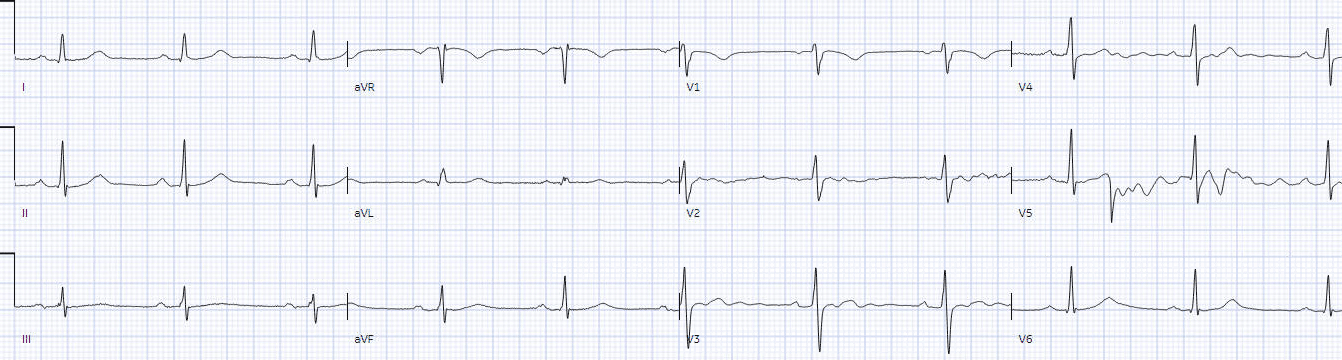 ECG Interpretation in Cardiac Arrest | ECG Cases | Emergency Medicine Cases
