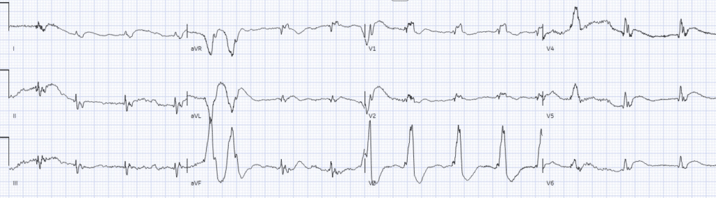 ECG Interpretation in Cardiac Arrest | ECG Cases | Emergency Medicine Cases
