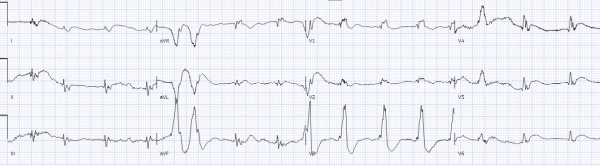 ECG Interpretation in Cardiac Arrest | ECG Cases | Emergency Medicine Cases