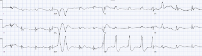 ECG Interpretation in Cardiac Arrest | ECG Cases | Emergency Medicine Cases