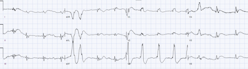ECG Interpretation in Cardiac Arrest | ECG Cases | Emergency Medicine Cases