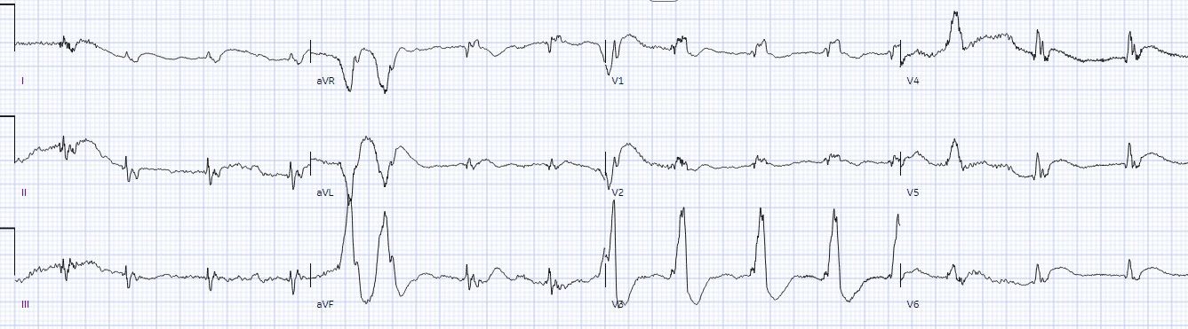 ECG Interpretation in Cardiac Arrest | ECG Cases | Emergency Medicine Cases