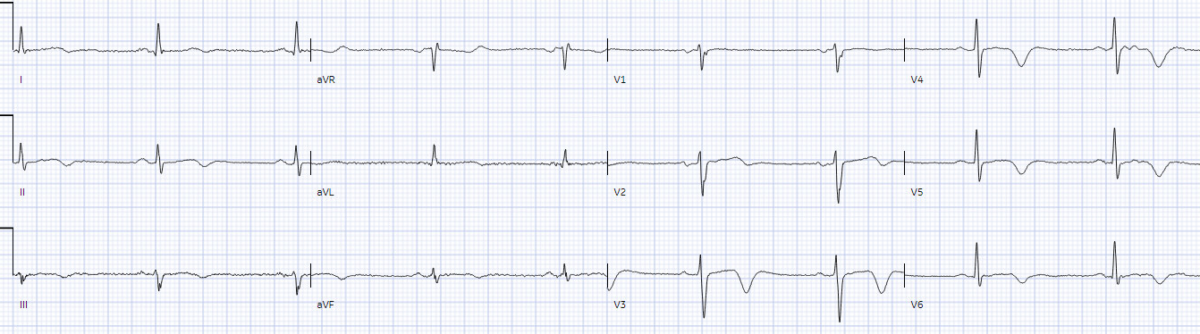 ECG Interpretation in Cardiac Arrest | ECG Cases | Emergency Medicine Cases