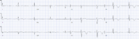 ECG Interpretation in Cardiac Arrest | ECG Cases | Emergency Medicine Cases