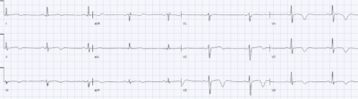 ECG Interpretation in Cardiac Arrest | ECG Cases | Emergency Medicine Cases