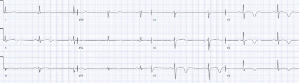 ECG Interpretation in Cardiac Arrest | ECG Cases | Emergency Medicine Cases
