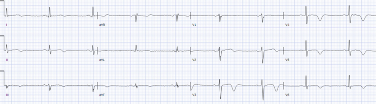 ECG Interpretation in Cardiac Arrest | ECG Cases | Emergency Medicine Cases