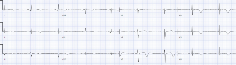 ECG Interpretation in Cardiac Arrest | ECG Cases | Emergency Medicine Cases