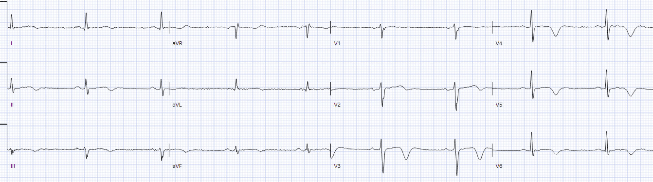 ECG Interpretation in Cardiac Arrest | ECG Cases | Emergency Medicine Cases