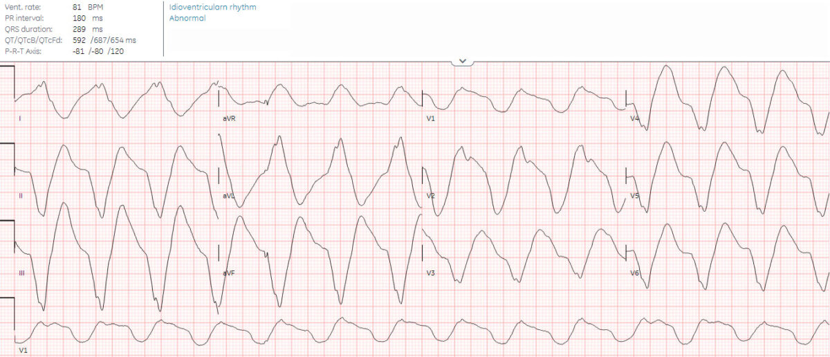 ECG Interpretation in Cardiac Arrest | ECG Cases | Emergency Medicine Cases