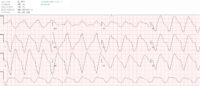 ECG Interpretation in Cardiac Arrest | ECG Cases | Emergency Medicine Cases