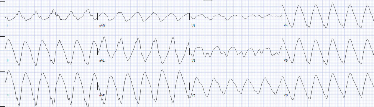 ECG Interpretation in Cardiac Arrest | ECG Cases | Emergency Medicine Cases