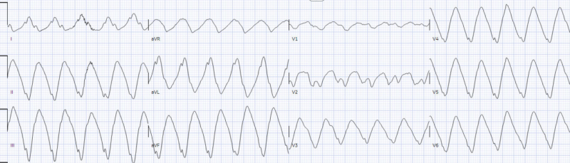 ECG Interpretation in Cardiac Arrest | ECG Cases | Emergency Medicine Cases