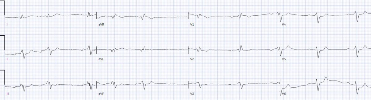 ECG Interpretation in Cardiac Arrest | ECG Cases | Emergency Medicine Cases