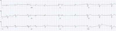 ECG Interpretation in Cardiac Arrest | ECG Cases | Emergency Medicine Cases